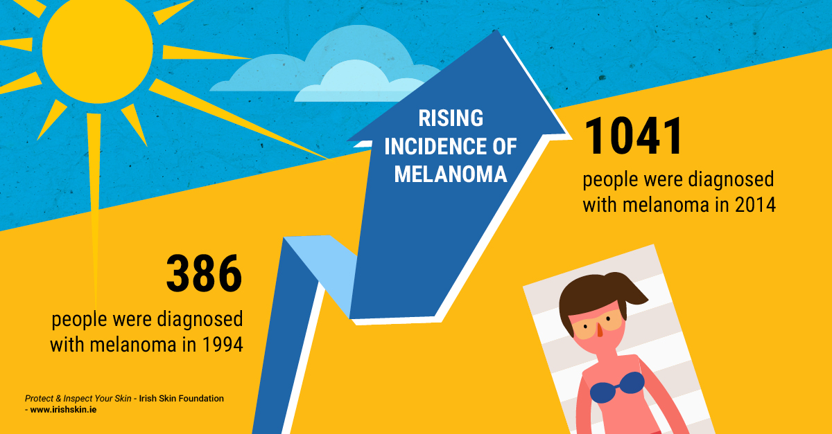 More than 1,000 melanoma skin cancers diagnosed in Ireland in one year