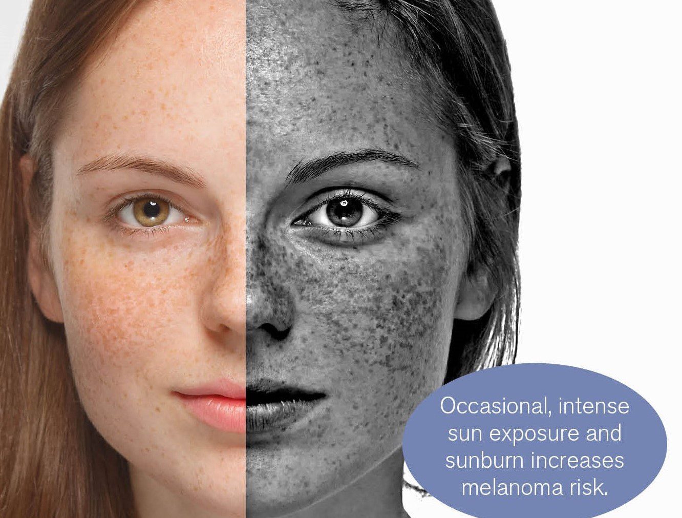 UCD Get Sun Smarter: Second Annual Sun Awareness Event to Prevent ...